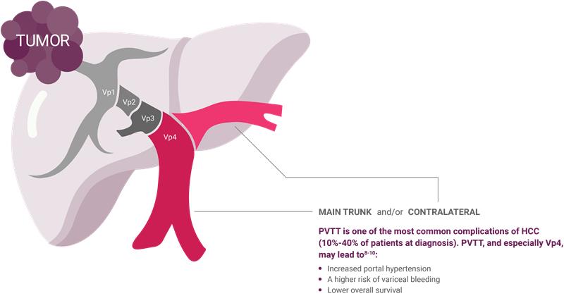 IMbrave150 Exploratory Analysis - Vp4 | TECENTRIQ® (atezolizumab)